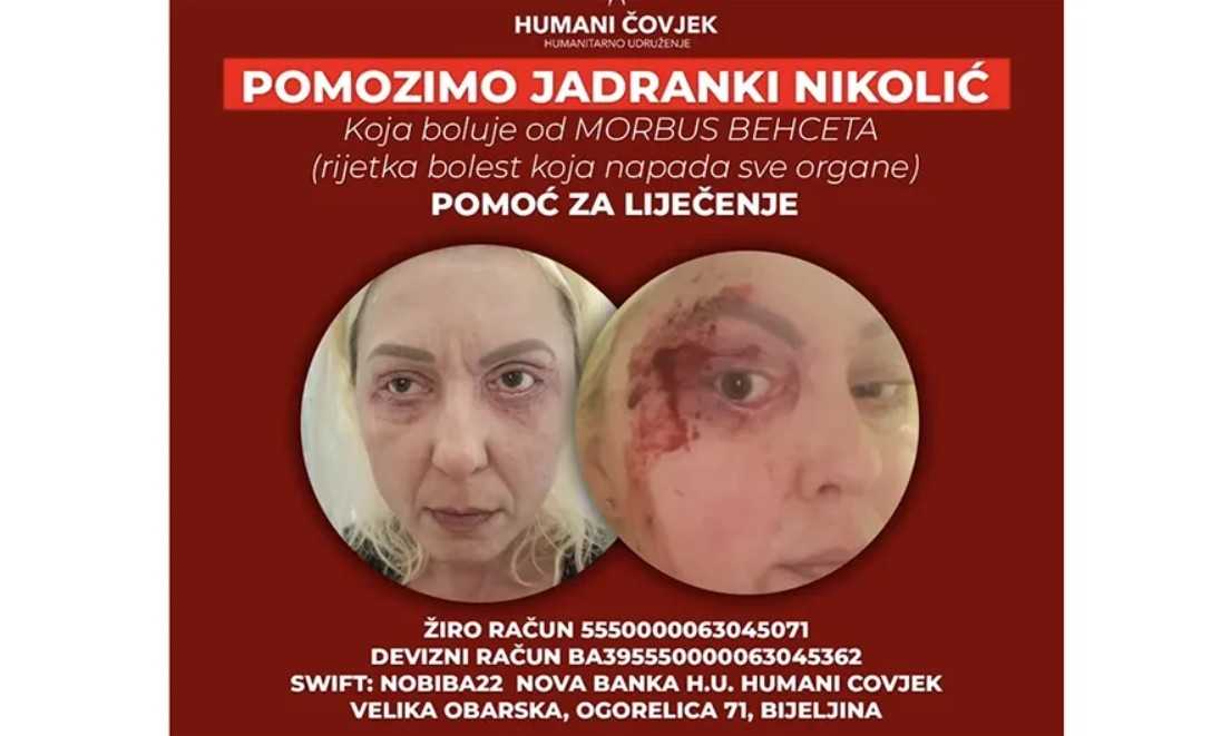 Humanost: Jadranka iz Bijeljine boluje od rijetke bolesti i treba našu ...